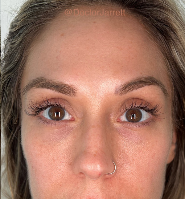 botox_Miami_after - Designer Aesthetics by Dr. Jarrett Schanzer | Miami