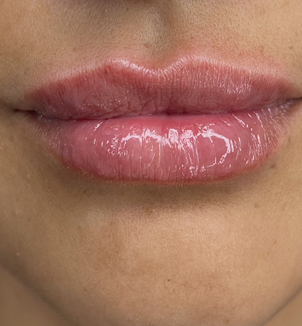 lips-after - Designer Aesthetics by Dr. Jarrett Schanzer | Miami