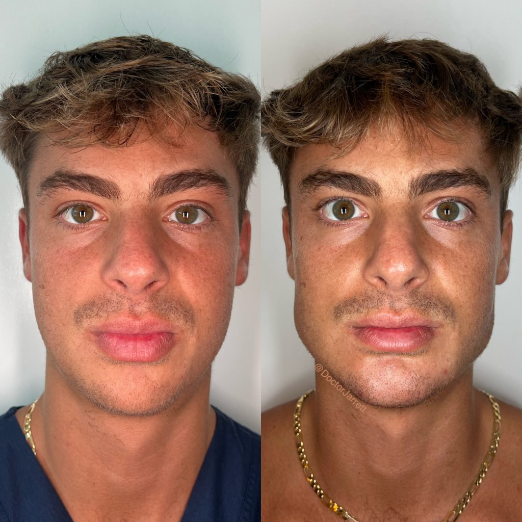 Chin_Jawline Contouring - Designer Aesthetics by Dr. Jarrett Schanzer ...
