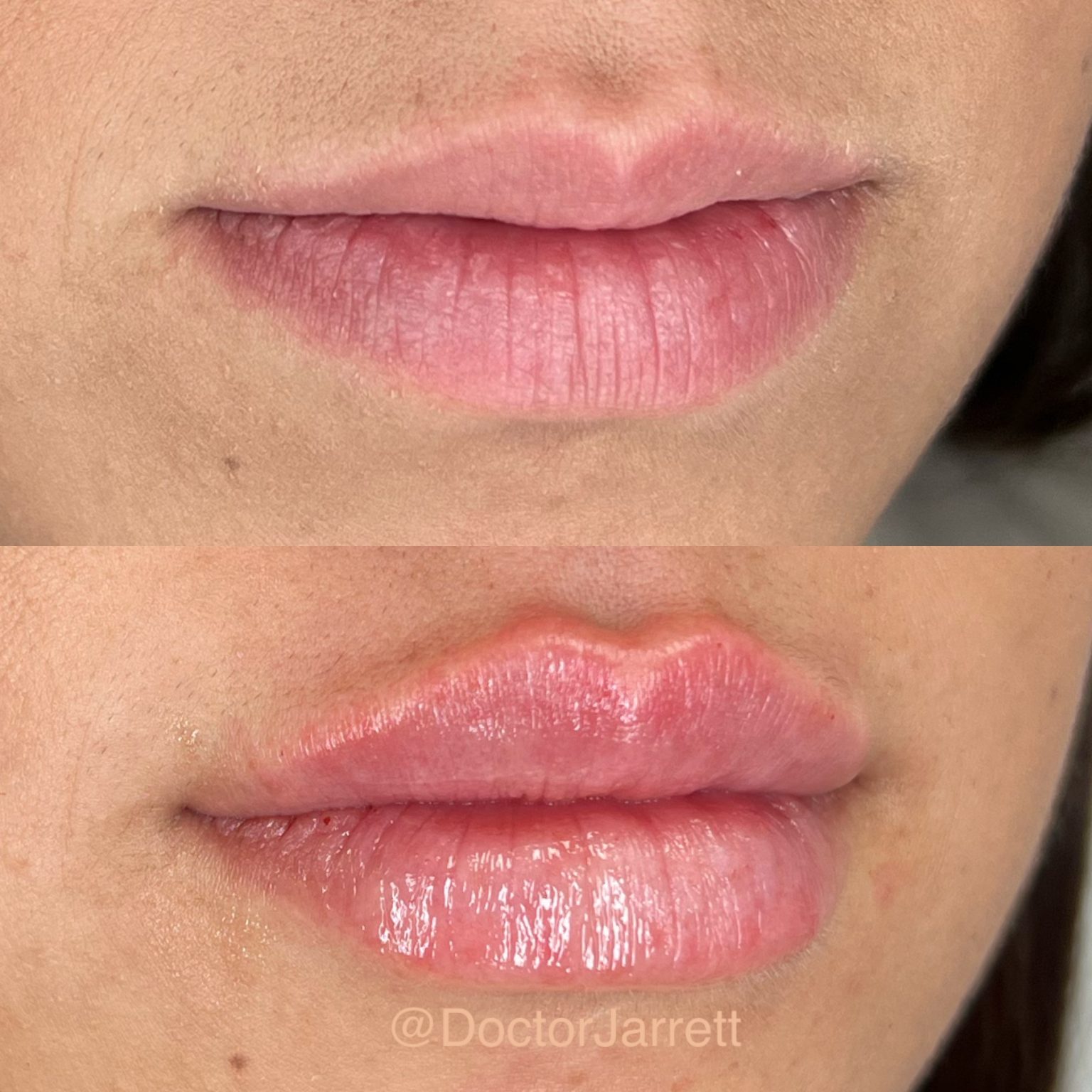 Lip_Filler_Miami - Designer Aesthetics by Dr. Jarrett Schanzer | Miami