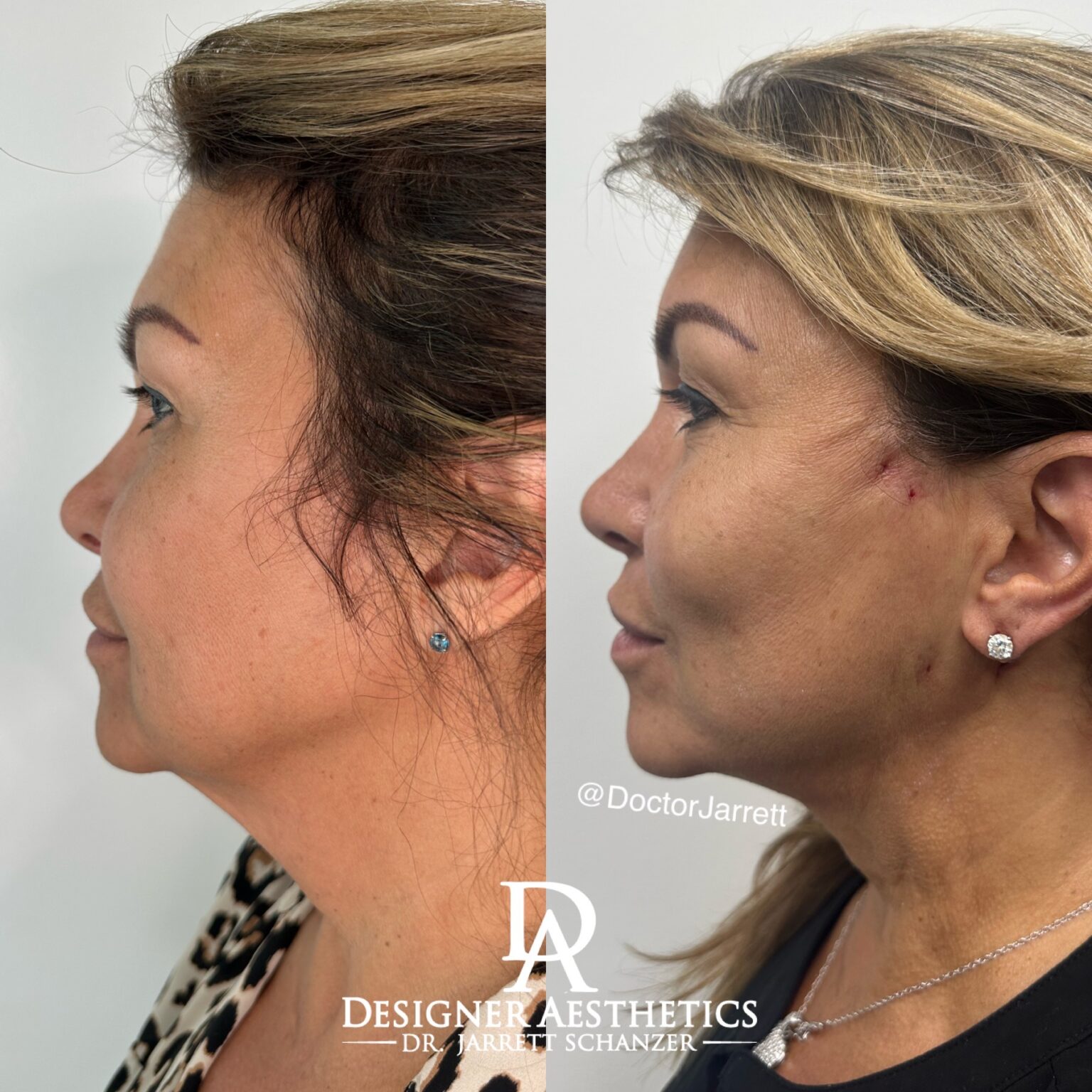 Jawline Contouring - Designer Aesthetics by Dr. Jarrett Schanzer | Miami