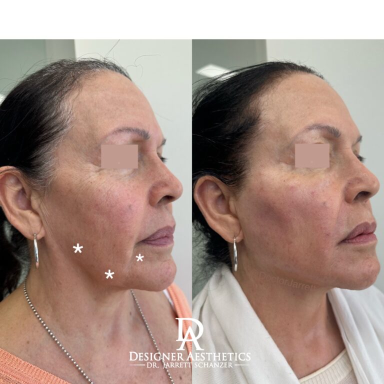 Jawline Contouring - Designer Aesthetics by Dr. Jarrett Schanzer | Miami