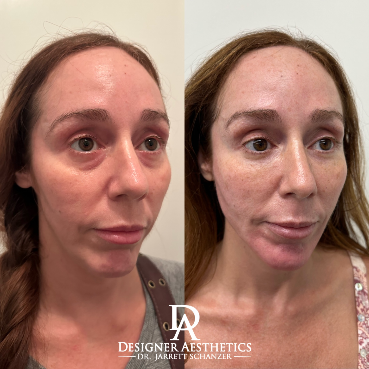 Facial balancing / full face rejuvenation miami aesthetics injections ...