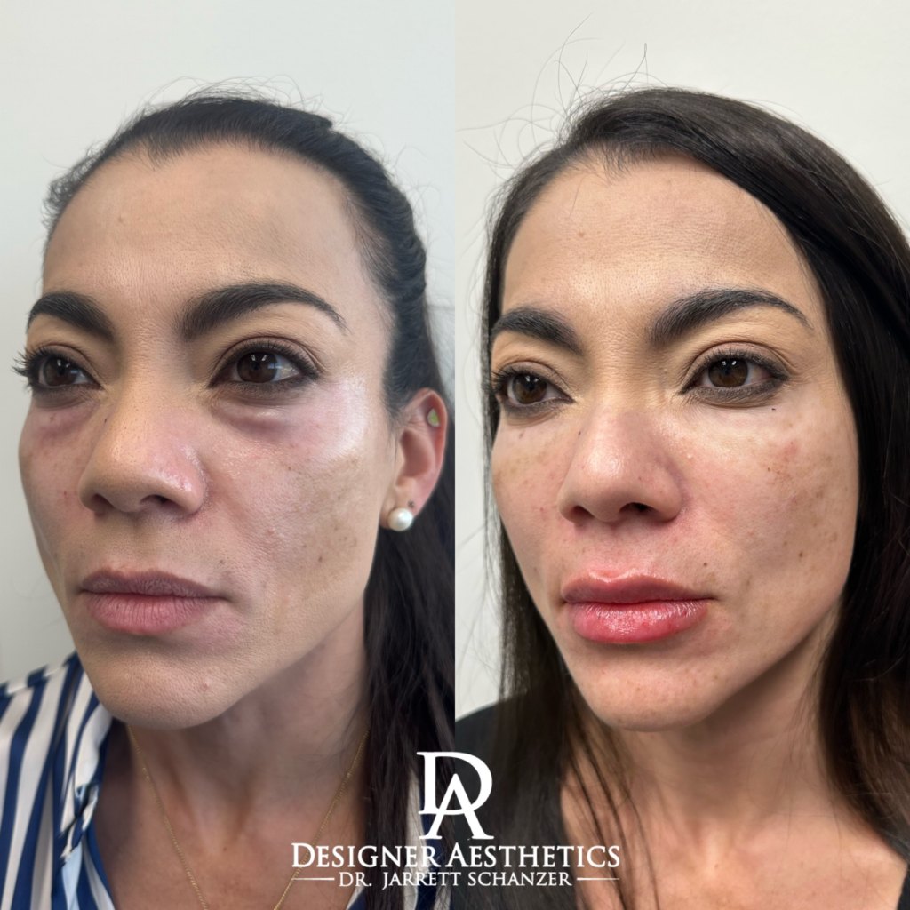 Facial balancing / full face rejuvenation - Designer Aesthetics by Dr ...