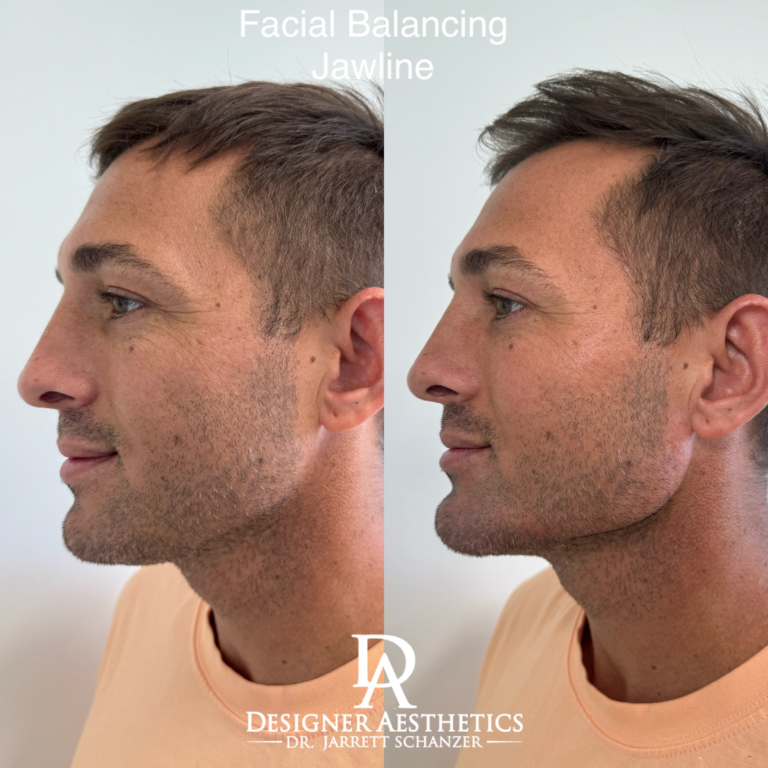 Jawline Contouring - Designer Aesthetics by Dr. Jarrett Schanzer | Miami