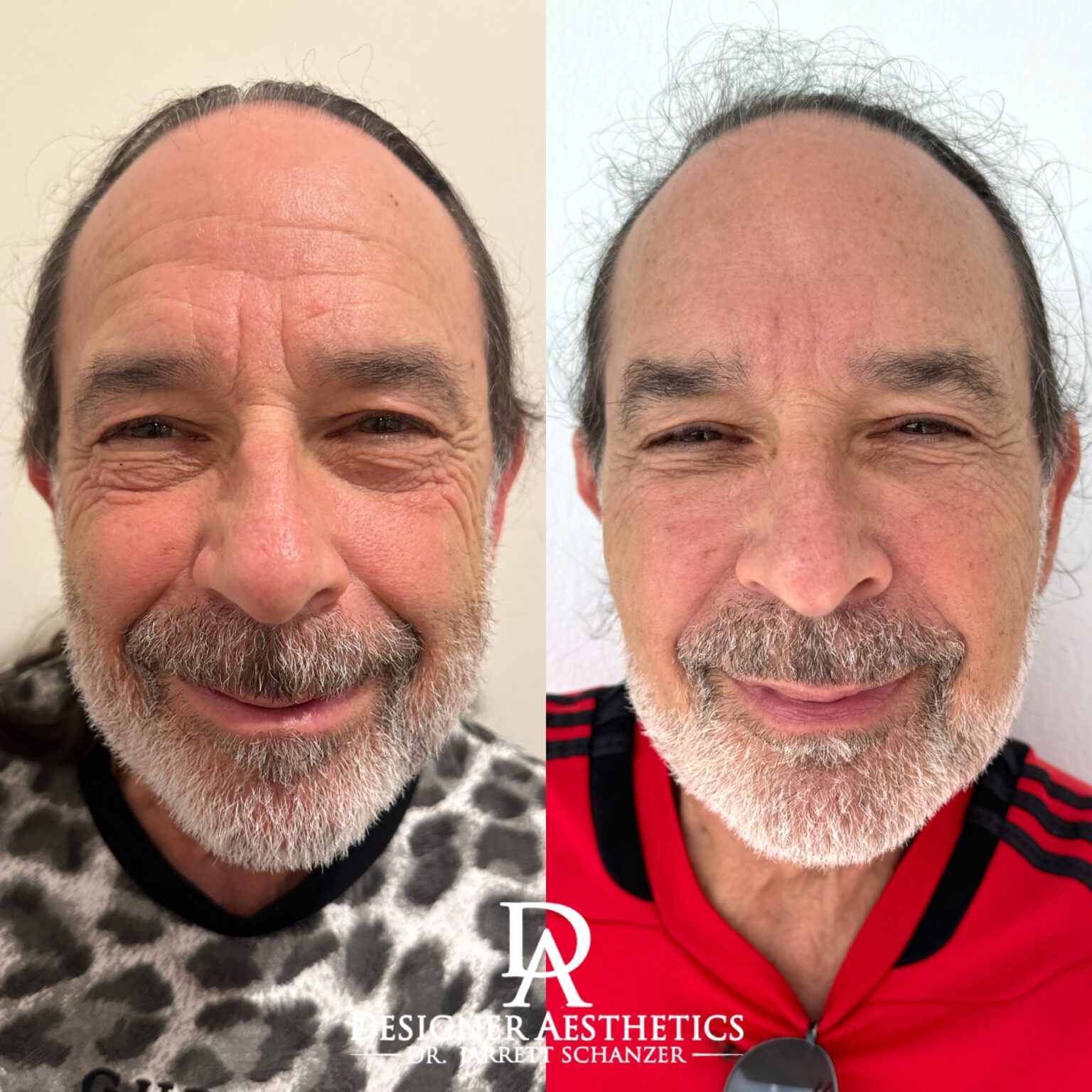 Facial balancing / full face rejuvenation - Designer Aesthetics by Dr ...