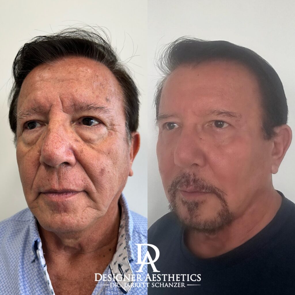 Facial balancing / full face rejuvenation - Designer Aesthetics by Dr ...