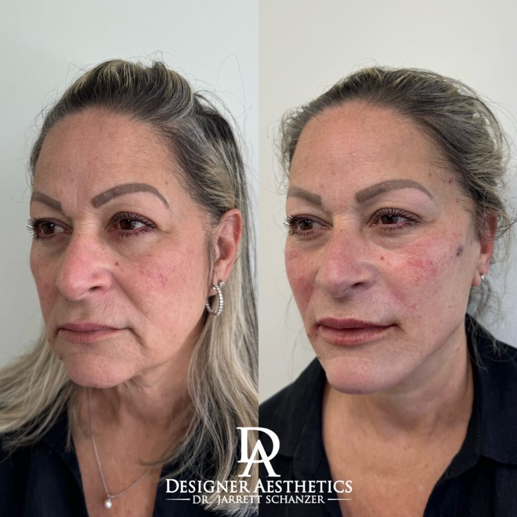 Facial balancing / full face rejuvenation - Designer Aesthetics by Dr ...