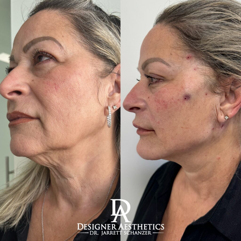 Neck Lift & Décolleté - Designer Aesthetics by Dr. Jarrett Schanzer | Miami
