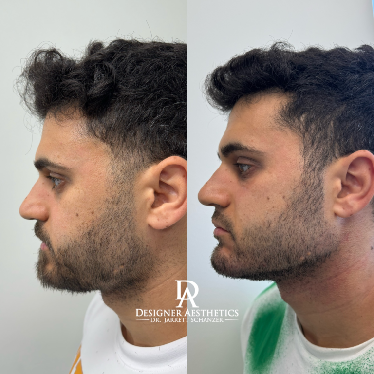 Jawline Contouring - Designer Aesthetics by Dr. Jarrett Schanzer | Miami